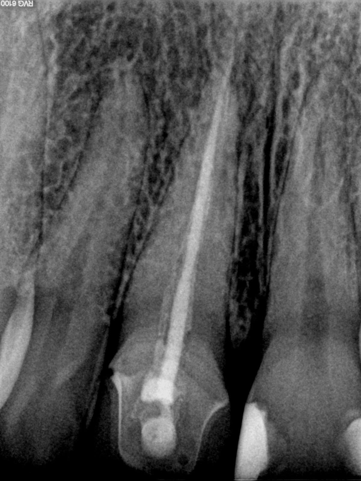 Apical lesions: To treat or not to treat?